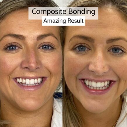 Composite Bonding: The Perfect Solution for Your Dental Needs - The ...
